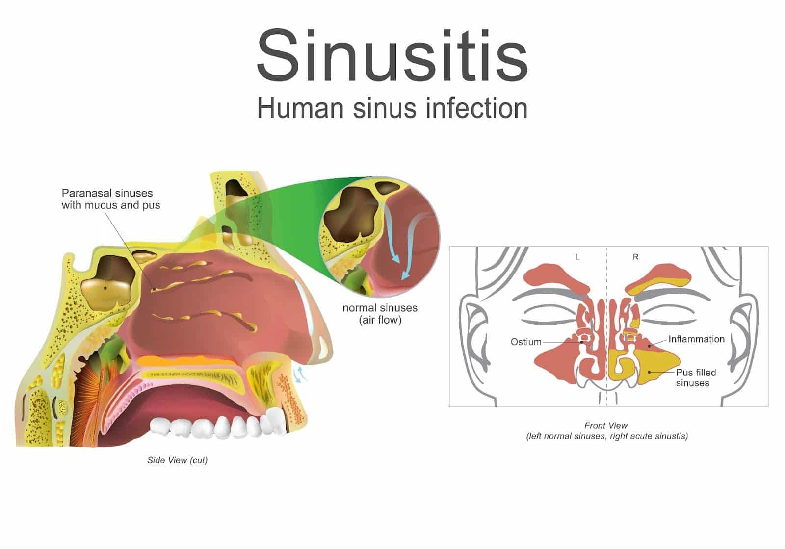 Are Sinus Infections Contagious? Here’s What You Need to Know - Family ...